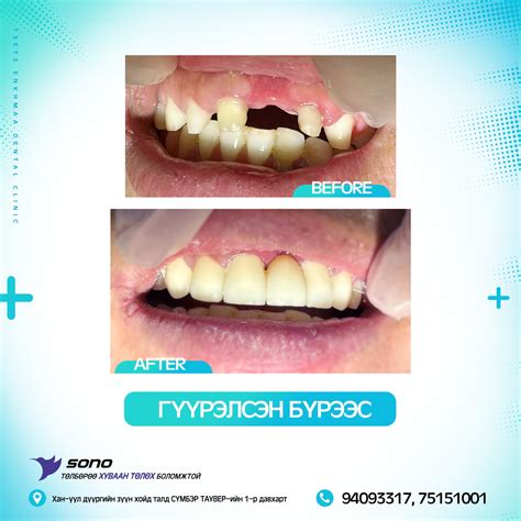 Цэц Металл шаазан гүүрэлсэн бүрээс 😊 ☝ Бүрээс буюу гүүрлэсэн