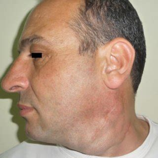 A The Preoperative View Of The Mass Anteriorly On The Left Side Of The Download Scientific