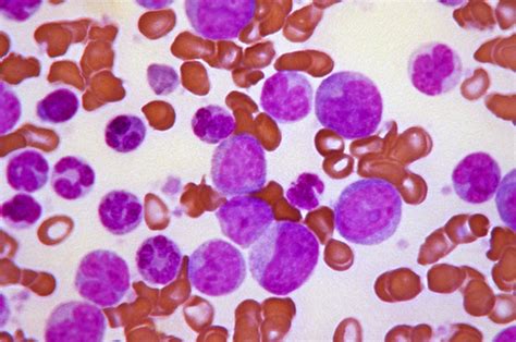 Blood Disease Leukemia Cancer Treatment Britannica