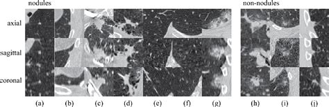 Figure 1 From Pulmonary Nodule Detection In Ct Images False Positive Reduction Using Multi View
