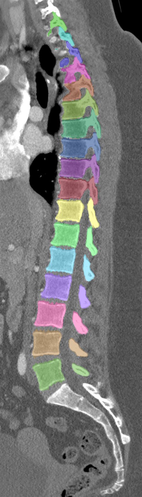 Spine And Vertebrae Segmentation Csi 2014 Workshop Challenge 1 Instance Segmentation Model V1