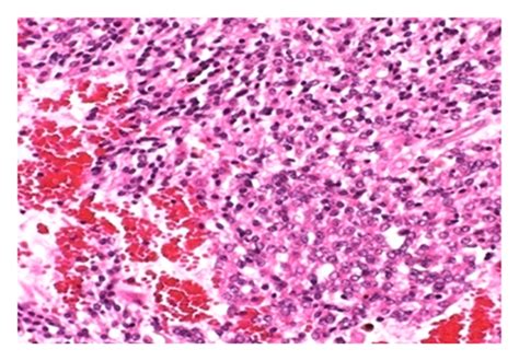 the distinction between epithelioid type lower side right and spindle