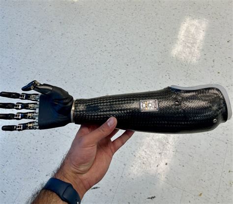 First Anatomical Suspension Myoelectric Control Transradial