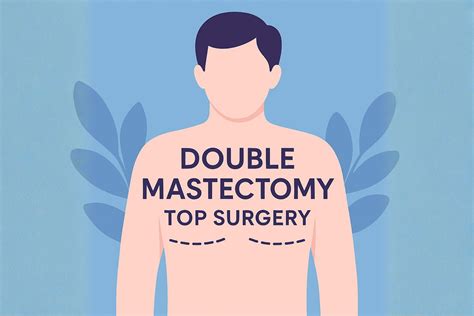 Double Mastectomy Surgery Uk Guide Gdt Gender Surgery