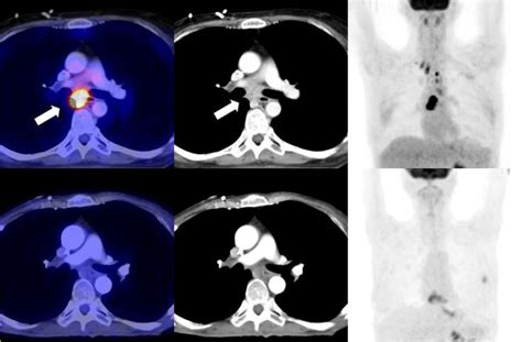 Patient 1 Upper Row Before Tuberculostatic Therapy High Fdg Uptake