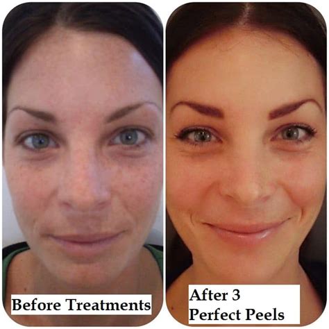 Chemical Peels For Fall And Why A Peel Is The Perfect Reset