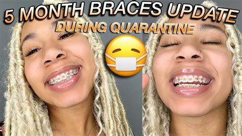5 Month Braces Update During Quarantine Vlog Kdiani Youtube 5 Month Braces Update During Quarantine Vlog Kdiani Youtube