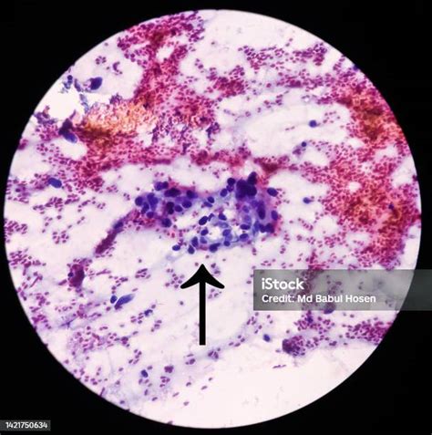 Intra Abdominal Mass Spindle Cell Sarcoma Positive Malignant Cells Pleomorphic Undifferentiated