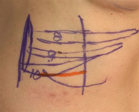 Right Subcostal Rib Removal Incision Dr Barry Eppley Indianapolis