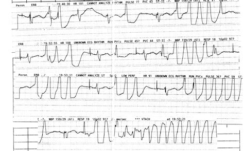 Ventricular Fibrillation Vs Torsades De Pointes