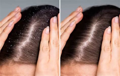 Types Of Dandruff And How To Prevent In Hindi