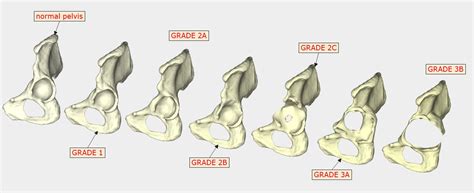Archivo Stl Clasificación De Paprosky De La Pérdida ósea Acetabular 🩻