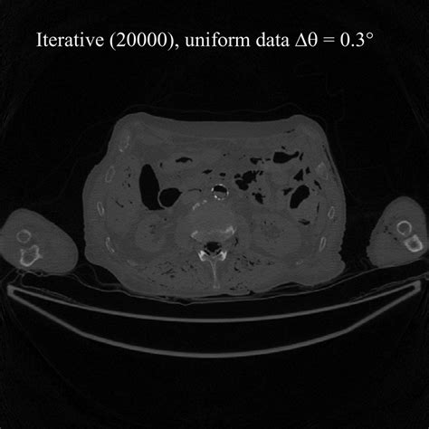 Iterative Landweber Reconstruction Of A Patient Torso Slice Using