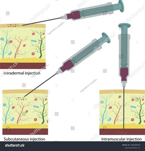 Types Injection Vaccination Active Immunizationintradermal Injection