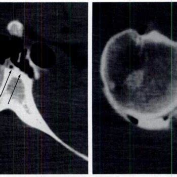 Anterior Labral Tear A CT Arthrogram With External Rotation Of Download Scientific Diagram