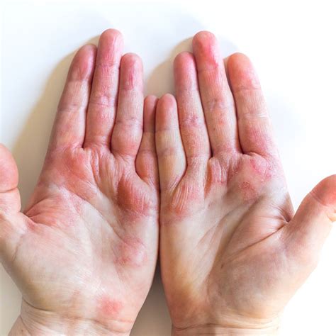 Understanding Eczema Causes Symptoms And Treatments