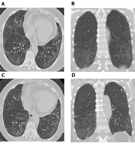 Imaging Features Of Systemic Sclerosis Associated Interstitial Lung Disease