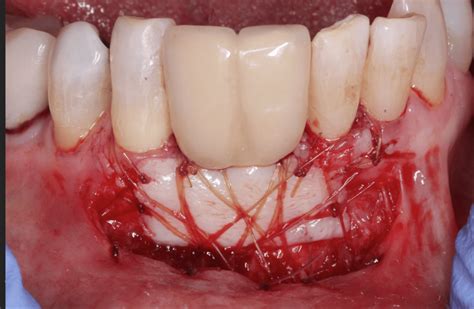 Gingival Graft