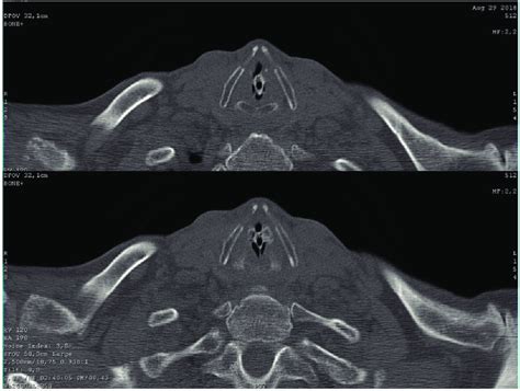 Head And Neck Computed Tomography Scan Download Scientific Diagram