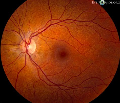 Atlas Entry Pseudoxanthoma Elasticum