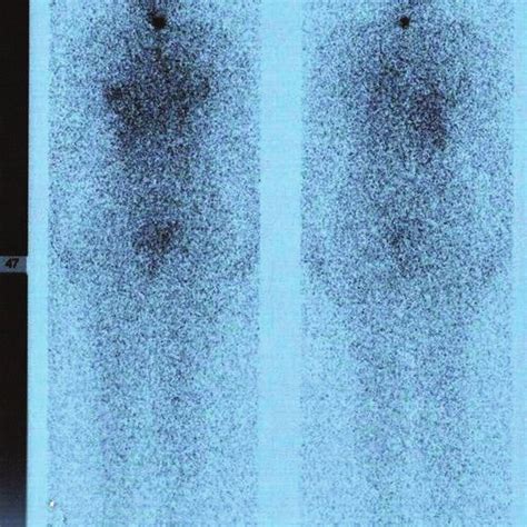 99m Tc Scintigraphy Showing A Hot Nodule At The Right Thyroid Region Download Scientific Diagram