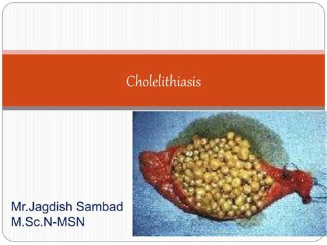Cholelithiasis Gall Stone Ppt