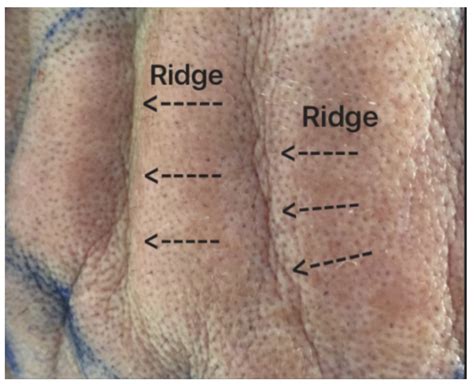 Diagnosis And Treatment Of Cutis Verticis Gyrata Cvg — Donovan Hair Clinic