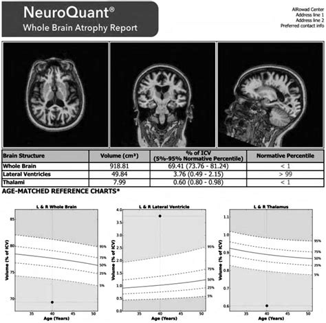 Fully Automated Segmentations Performed By Neuroquant®2 0 Shows Whole