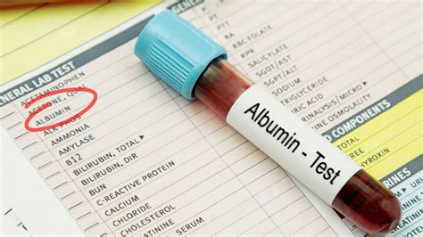 Urine Albumin To Creatinine Ratio 100 Best Calculator