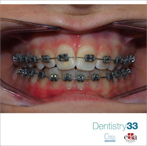 Roth Versus MBT Does Bracket Prescription Have An Effect On The Subjective Outcome Dentistry33