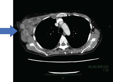 A Ct Scan Section Showing Right Axillary Lymph Nodes Before