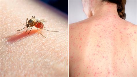 Ya Son 2942 Los Casos De Dengue Y 158 Los De Sarampión En La Argentina