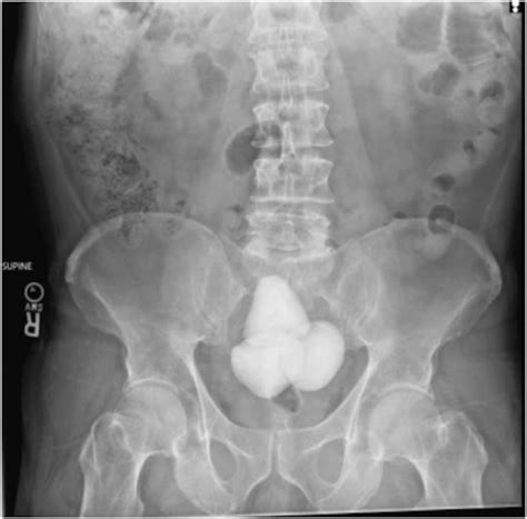X Ray Reveals Gigantic Bladder Stones Auntminnie