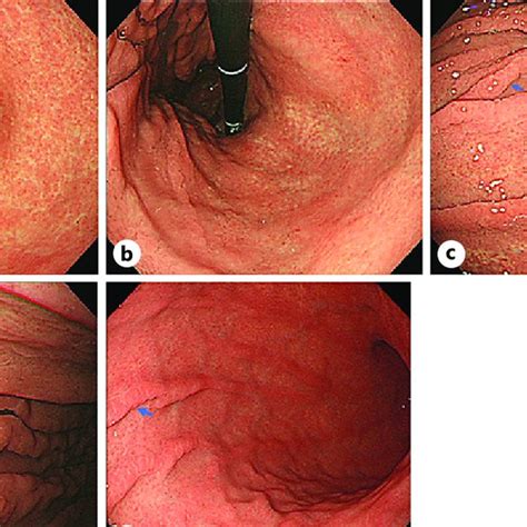 Endoscopic Findings In 2019 A D And 2020 E A B Mucosal Atrophy In