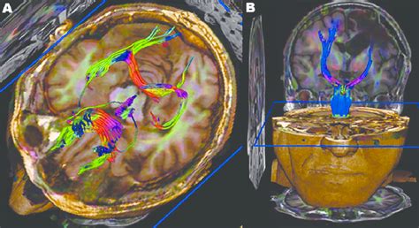 The Patients Diffusion Tensor Imaging Single Shot Epi Pulse Sequence