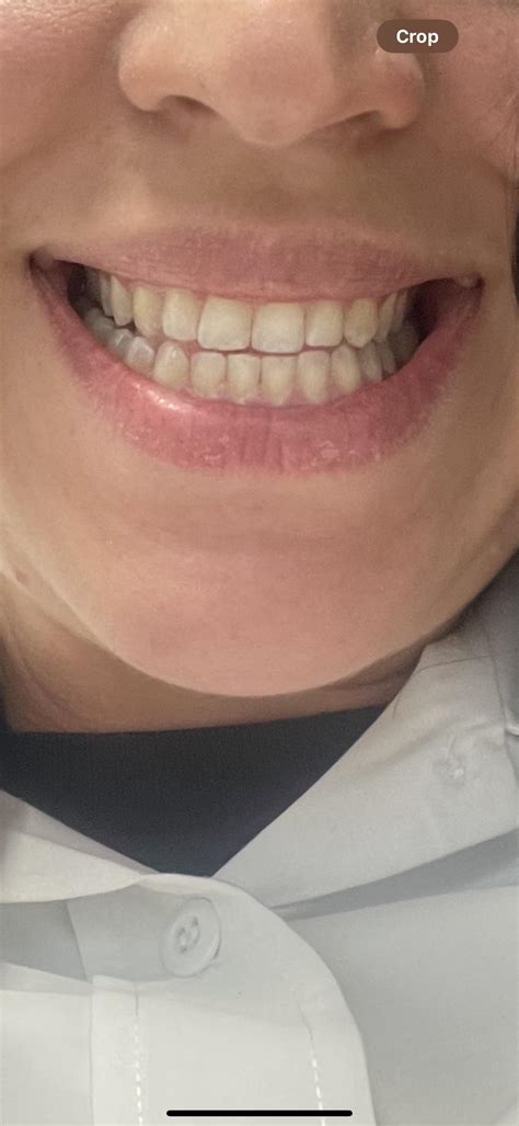 Braces Progress Scrolller Braces Progress Scrolller