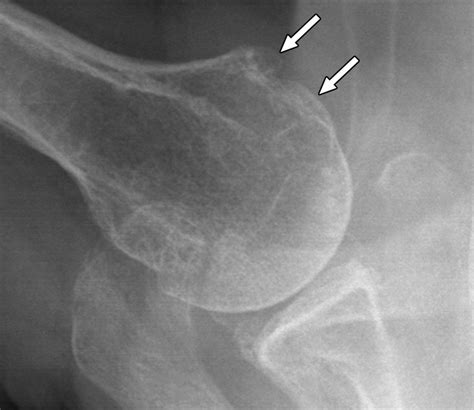 Lesser Tuberosity