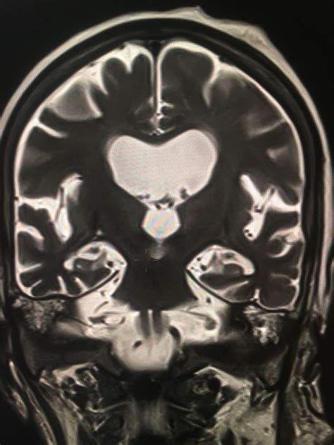 Bilateral Mts With Diffuse Cortical Atrophy