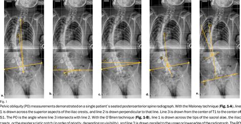 Figure 1 From The Variability Of Pelvic Obliquity Measurements In Patients With Neuromuscular