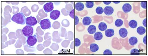 Ijms Free Full Text T Cell Prolymphocytic Leukemia Diagnosis Pathogenesis And Treatment