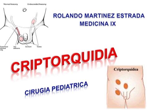 Criptorquidia