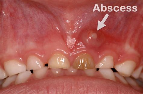 Periodontal Abscess Vs Periapical Abscess