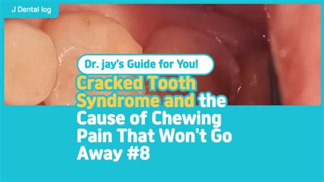 Cracked Tooth Syndrome And The Cause Of Chewing Pain That Wont Go Away