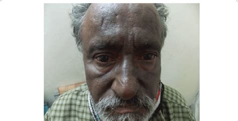 Hyperpigmentation Of Facial Skin And Skin Over Eyelids Figure 5