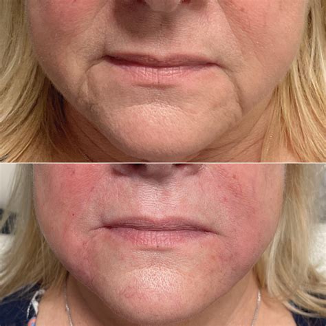 Marionette Lines Before And After