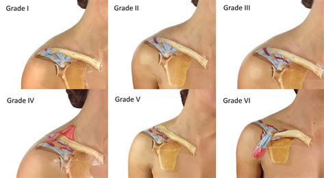 Acromioclavicular Joint Acromioclavicular Joint Injury Separation