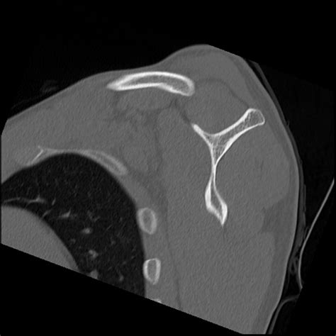 Normal Ct Shoulder Radiopaedia 60106 67676 Sagittal Bone Window Nc Commons