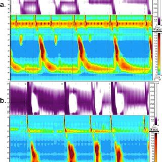 High Resolution Manometry Findings A Normal Motility Was Revealed