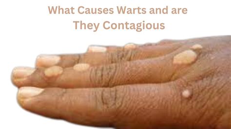 What Causes Warts And Are They Contagious Youtube