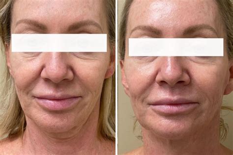 Quanta Light Evo And Suprema Laser Before And After Photos Archives